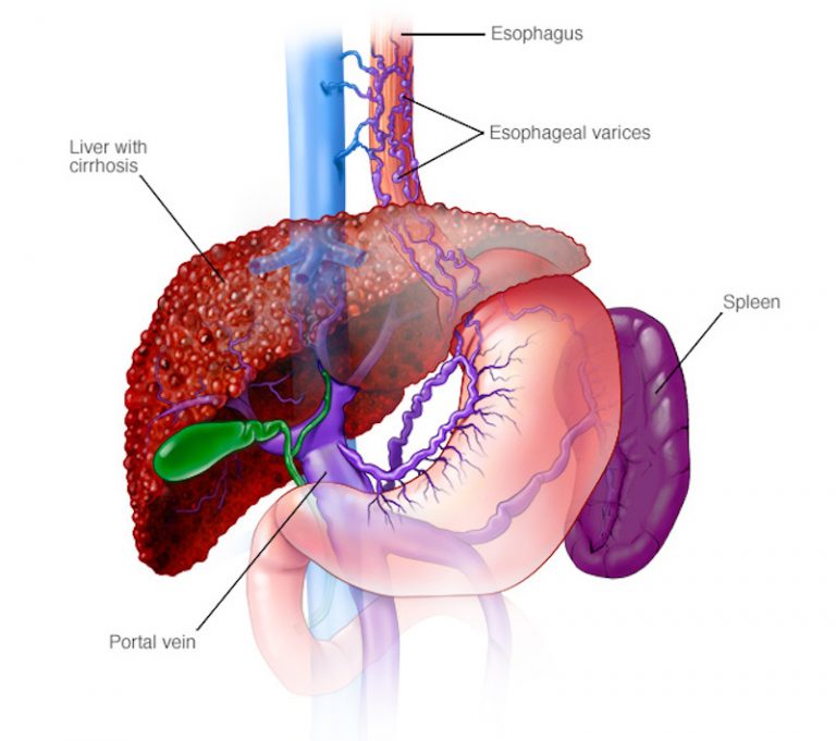 Pooping Blood? Here are Some Common Causes of Blood in Stool | Page 10 ...