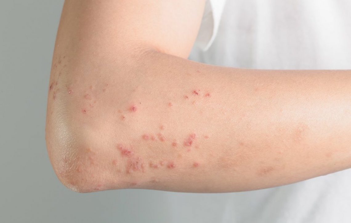 10 Serious Conditions That Rashes And Hives Can Indicate | Things Health