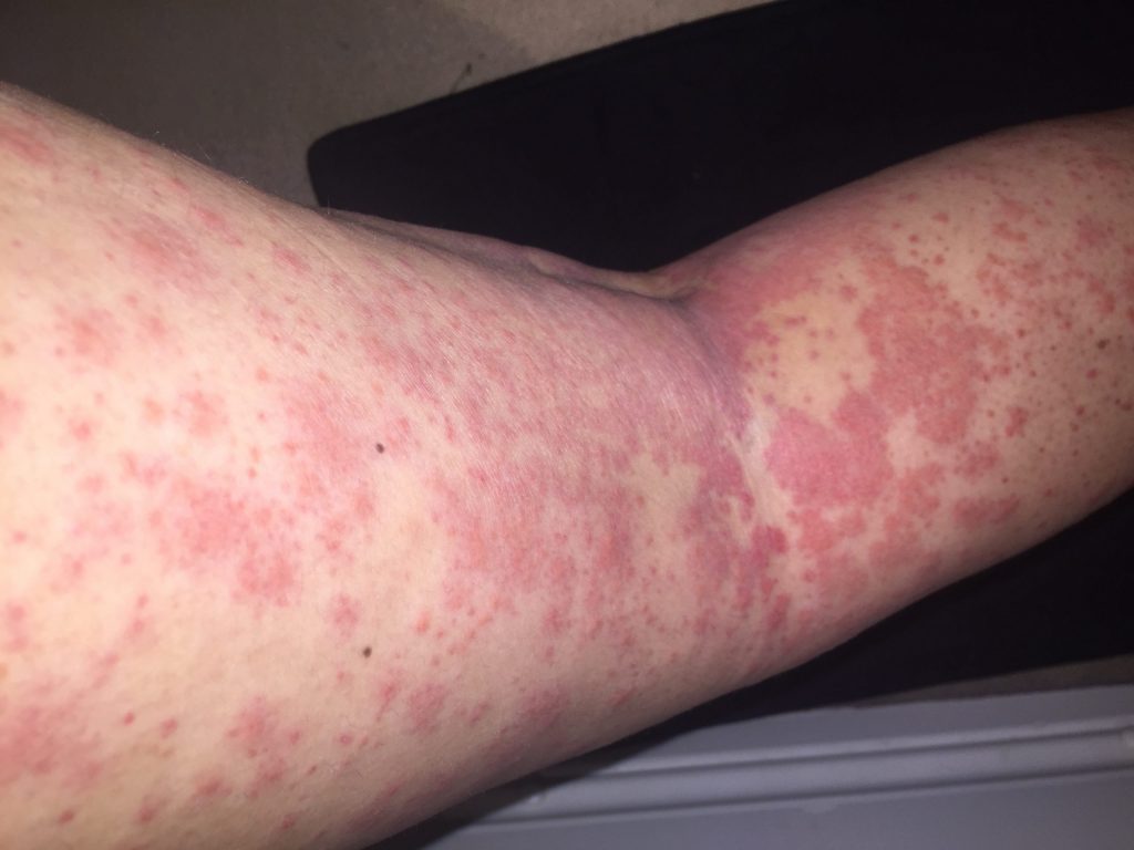 10 Serious Conditions That Rashes And Hives Can Indicate | Page 2 ...