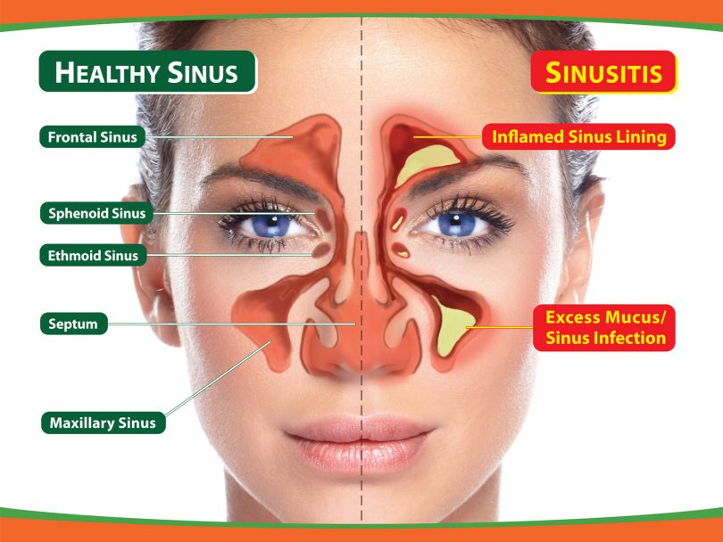 Symptoms Of A Sinus Infection | Things Health