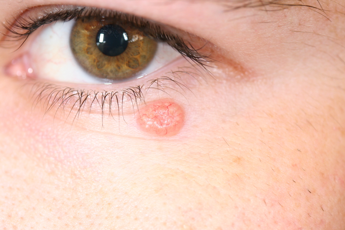 Warning Signs And Symptoms Of Non Melanoma Skin Cancer Things Health