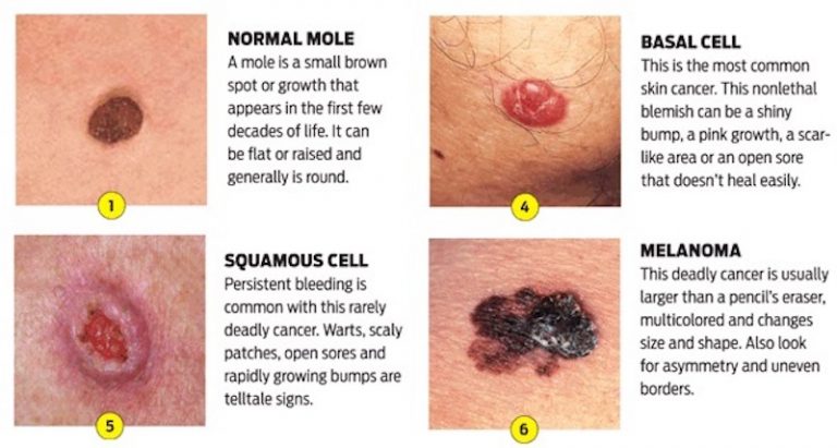 Warning Signs and Symptoms of Non-Melanoma Skin Cancer | Page 6 ...