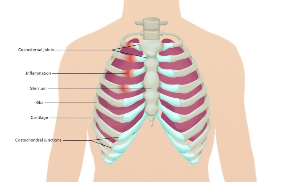 10 Causes of Chest Pain That Are Not Your Heart | Page 9 | Things Health