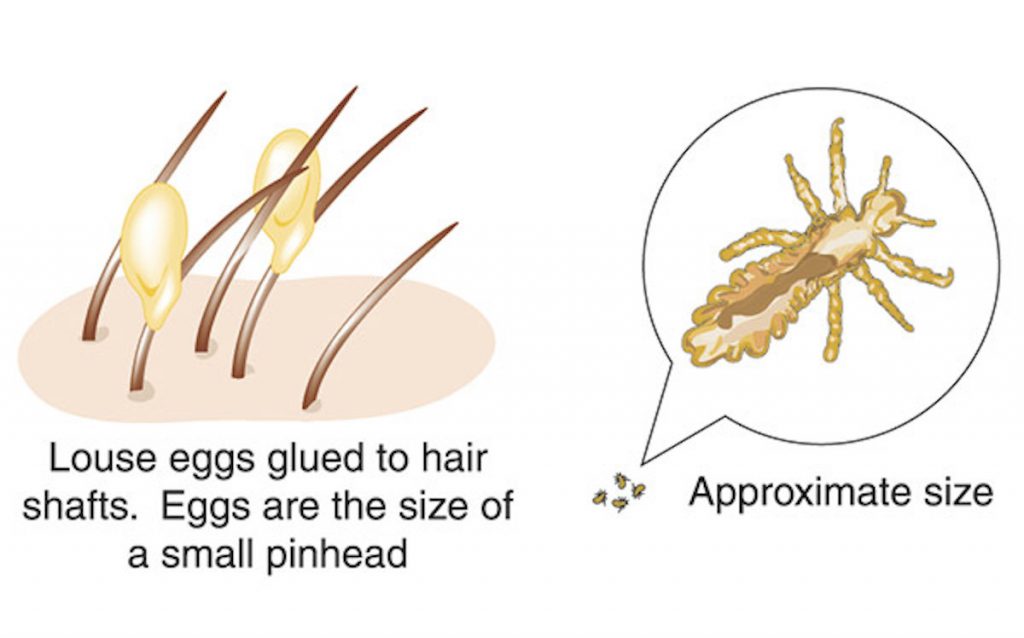 Treating and Preventing a Head Lice Infestation | Things Health