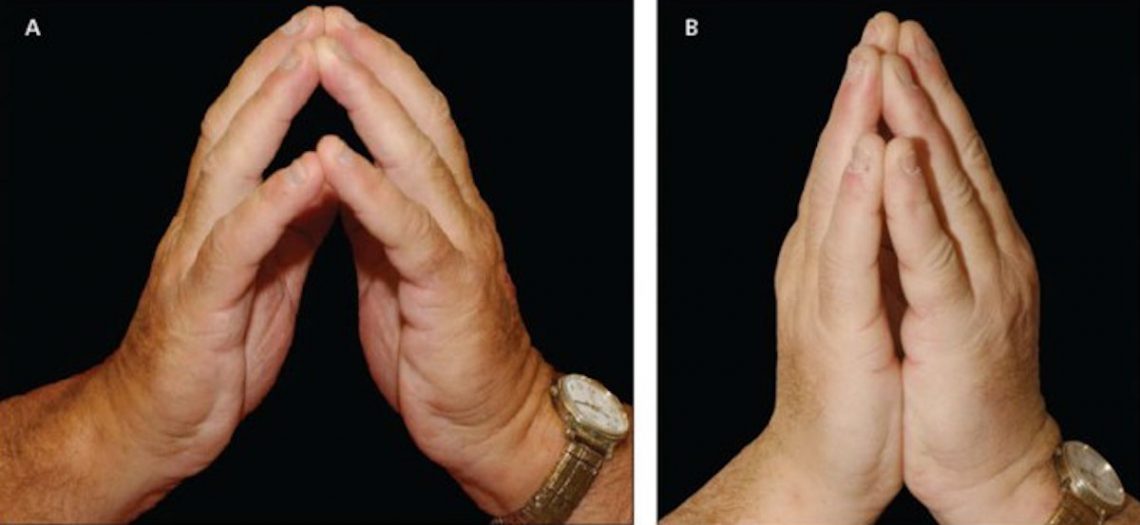 6 Warning Signs of Pre-diabetes | Things Health