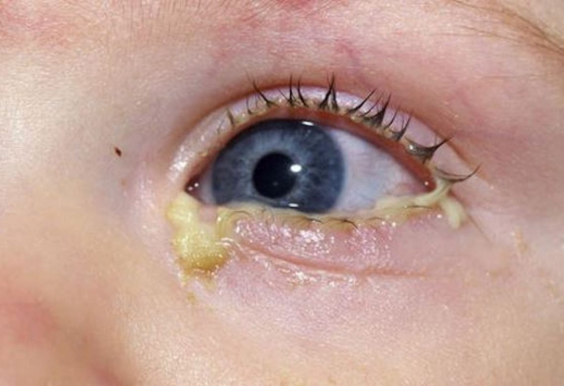 Pink Eye (conjunctivitis) - Symptoms and Treatment | Things Health