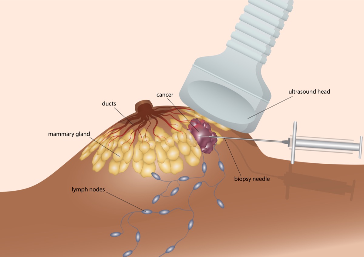 Diagnosis And Staging Of Inflammatory Breast Cancer Things Health Diagnosis And Staging Of Inflammatory Breast Cancer Things Health