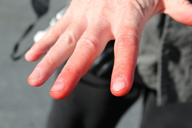 Frostbite : Signs, Symptoms, and Treatment | Things Health