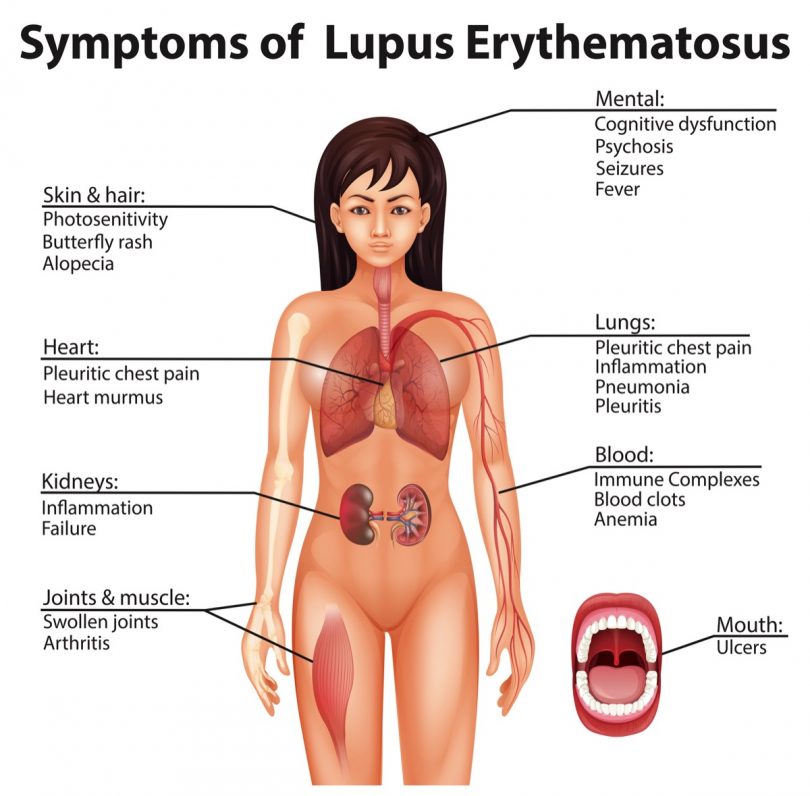 The Most Common Symptoms Of Lupus Page 16 Things Health