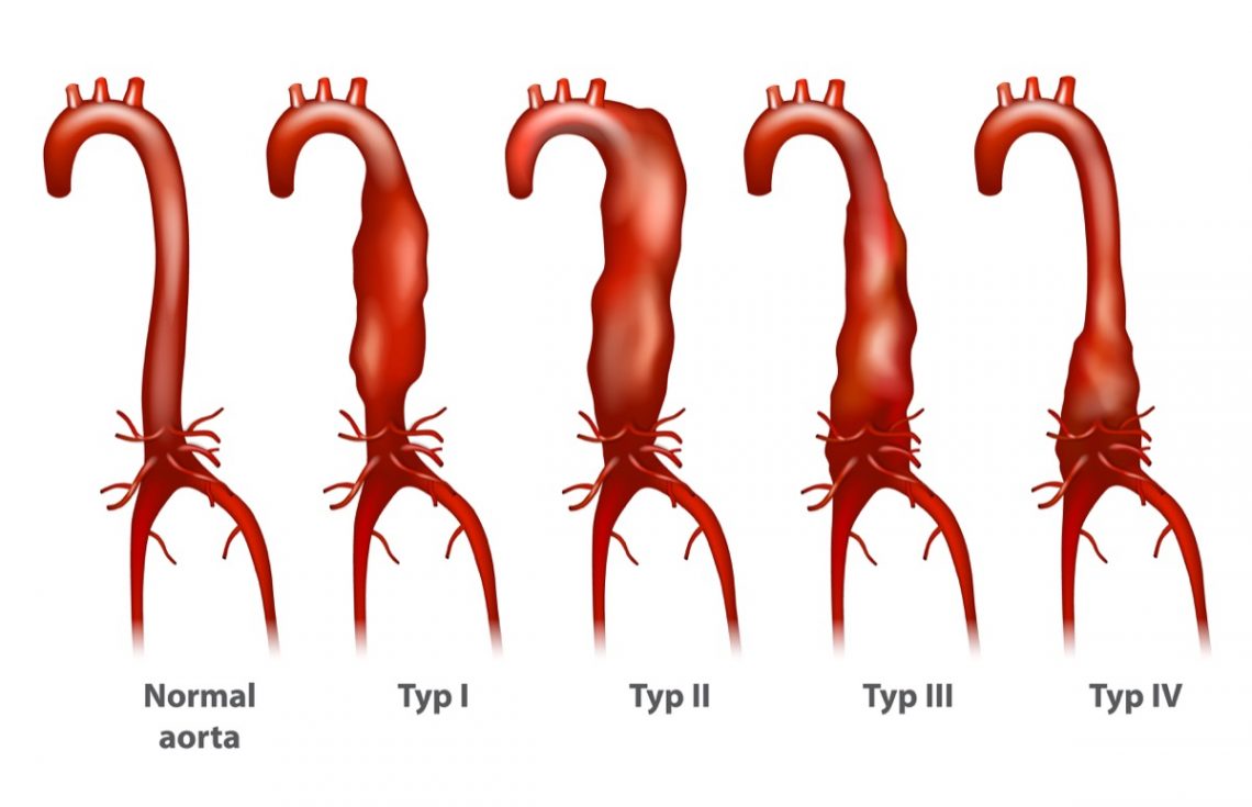 Understanding Marfan’s Syndrome | Page 4 | Things Health