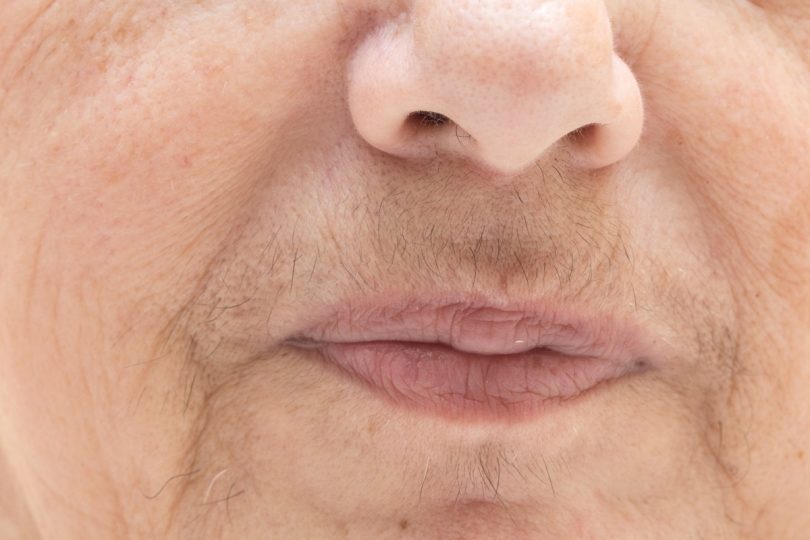 Hirsutism - Unwanted Hair Growth in Women | Page 2 | Things Health